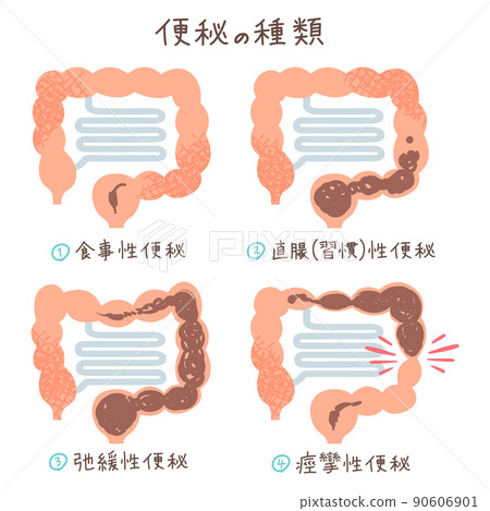 Illustration material of the type of constipation - Stock Illustration ...