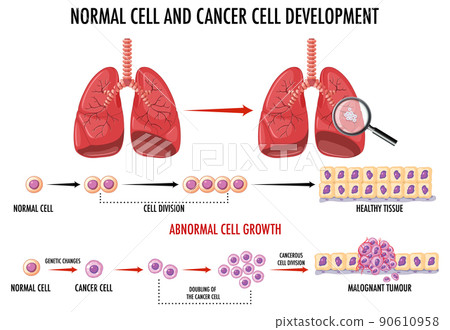 Diagram showing normal and cancer cells - Stock Illustration [90610958 ...