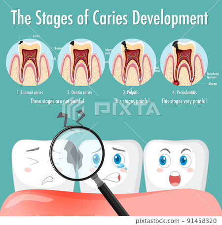 Infographic of human in stages of caries... - Stock Illustration ...
