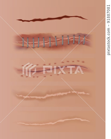 Healing wounds set, skin scars, stitched gash... - Stock Illustration ...