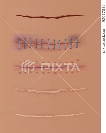 Healing wounds set, skin scars, stitched gash... - Stock Illustration ...