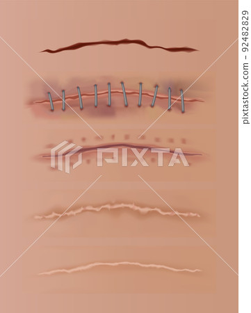 Healing wounds set, skin scars, stitched gash... - Stock Illustration ...