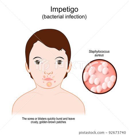 Impetigo. Face baby with a skin infection - Stock Illustration ...