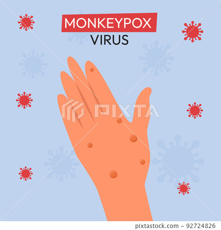 Monkeypox outbreak. Monkeypox are shown on the... - Stock Illustration ...
