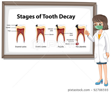 Infographic of human in the stages of tooth decay - Stock Illustration ...