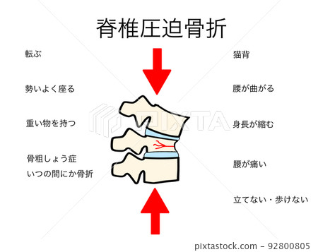 Illustration of spinal compression fracture - Stock Illustration ...