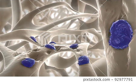 Disrupting bone structure, Rheumatoid Arthritis - Stock Illustration ...