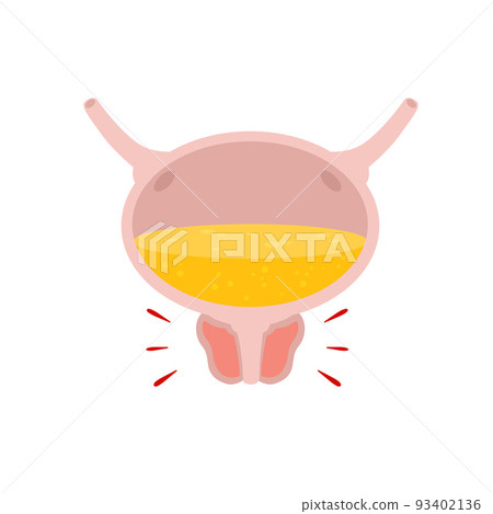 Inflammation of prostate. Scheme of health and...-插圖素材 [93402136] - PIXTA圖庫