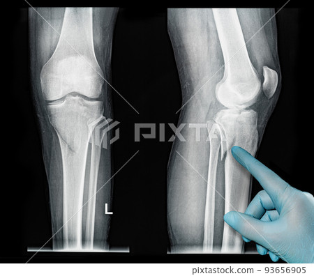 X Ray Leg Fracture Pinned Leg Fracture, X Ray Stock Image