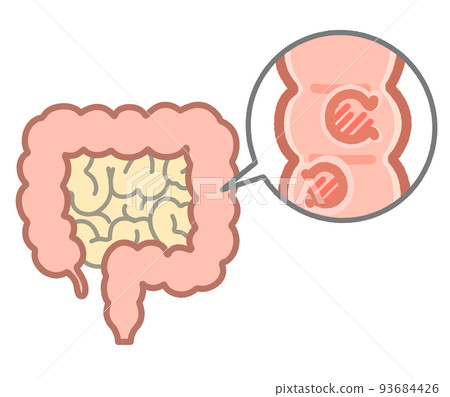 Explanation illustration of colon polyps - Stock Illustration [93684426 ...