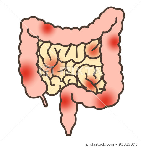 Crohn's disease classification illustration... - Stock Illustration ...