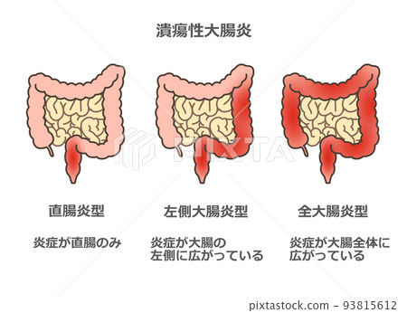 Ulcerative colitis - Stock Illustration [93815612] - PIXTA