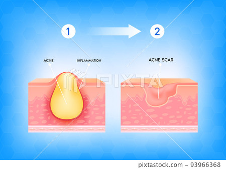 Inflamed acne on the skin. Inflammation... - Stock Illustration ...