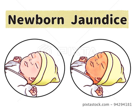 Illustration material of newborn jaundice... - Stock Illustration ...