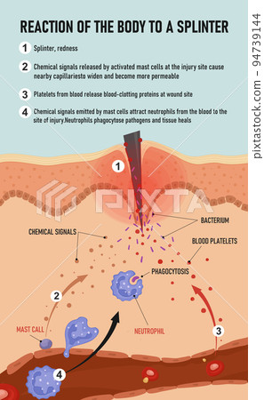 Reaction of the body to a splinter.... - Stock Illustration [94739144 ...