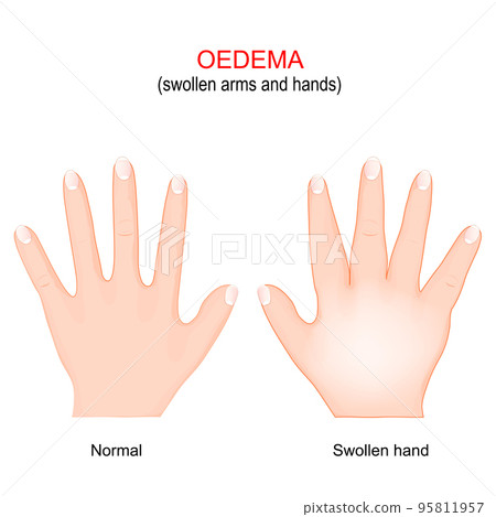 Pitting Edema Hand