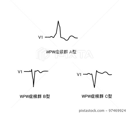 Electrocardiogram of WPW syndrome - Stock Illustration [97469924] - PIXTA