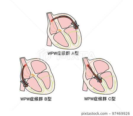 WPW Syndrome (A/B/C) - Stock Illustration [97469926] - PIXTA