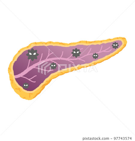 Illustration of pancreatitis - Stock Illustration [97743574] - PIXTA
