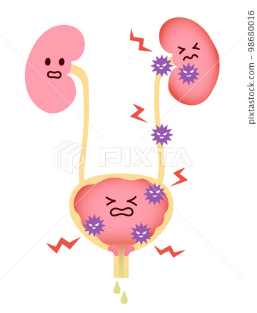 Illustration of cystitis and pyelonephritis - Stock Illustration ...