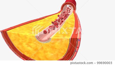 Atherothrombosis is a cardiovascular disease... - Stock Illustration ...
