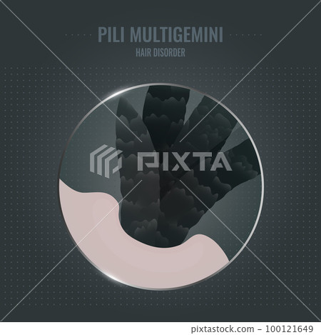 Pili multigemini hair disorder in close up-插圖素材 [100121649] - PIXTA圖庫