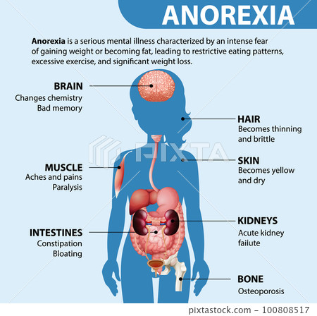Informative poster of Anorexia eating disorder - Stock Illustration ...