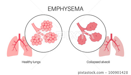 Emphysema anatomical poster-插圖素材 [100901428] - PIXTA圖庫