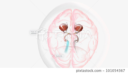 Strabismic Amblyopia, Visual Pathway with Eye... - Stock Illustration ...