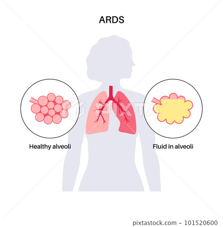 ARDS anatomical poster-插圖素材 [101520600] - PIXTA圖庫