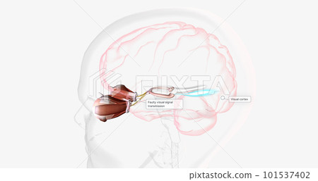 Strabismic Amblyopia, Visual Pathway with Eye... - Stock Illustration ...