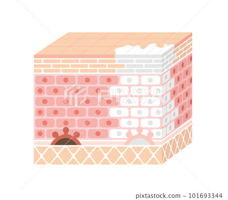 Illustration of causes and symptoms of vitiligo... - Stock Illustration ...