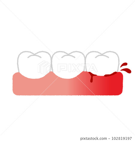illustration of gingivitis - Stock Illustration [102819197] - PIXTA
