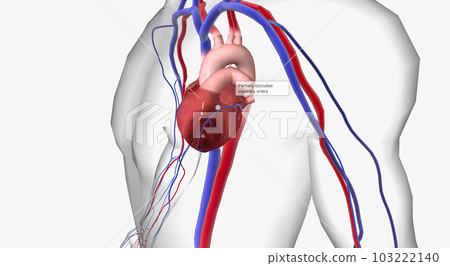 Angina is chest pain or discomfort due to... - Stock Illustration ...