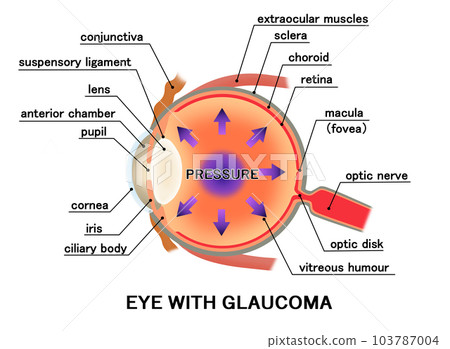 Glaucoma diagram, infographic, English - Stock Illustration [103787004 ...