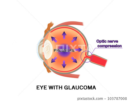 Glaucoma diagram, infographic, English - Stock Illustration [103787008 ...