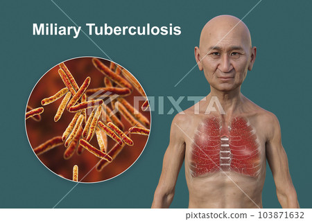 Miliary Tuberculosis Skin
