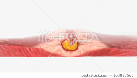 Atherosclerosis can sometimes narrow arteries... - Stock Illustration ...