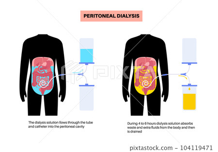 Peritoneal dialysis concept - Stock Illustration [104119471] - PIXTA