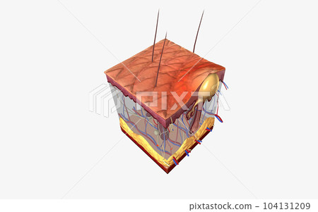 Closed comedones (whiteheads) are a type of... - Stock Illustration ...