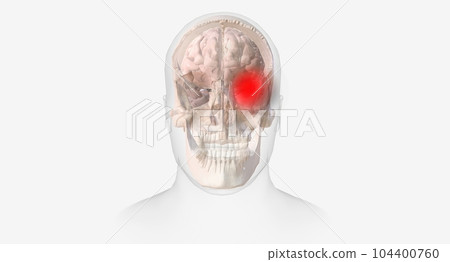 Cluster Headache Illustration