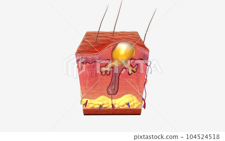 Pustules are a type of acne characterized by... - Stock Illustration ...