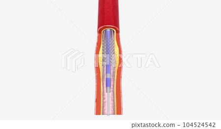 Angioplasty is a minimally invasive procedure... - Stock Illustration ...