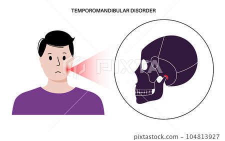 TMD TMJ disorder - Stock Illustration [104813927] - PIXTA