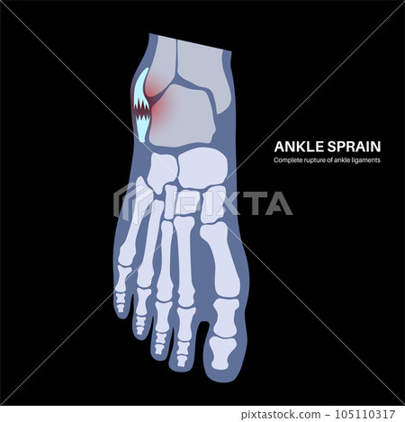 Sprained ankle injury - Stock Illustration [105110317] - PIXTA
