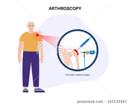 Shoulder arthroscopy poster - Stock Illustration [105539361] - PIXTA