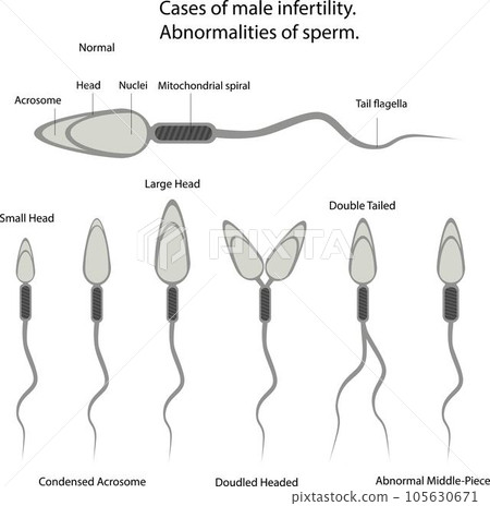 Vector illustration cases of male infertility.... - Stock Illustration ...