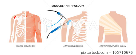 Shoulder arthroscopy poster - Stock Illustration [105710676] - PIXTA