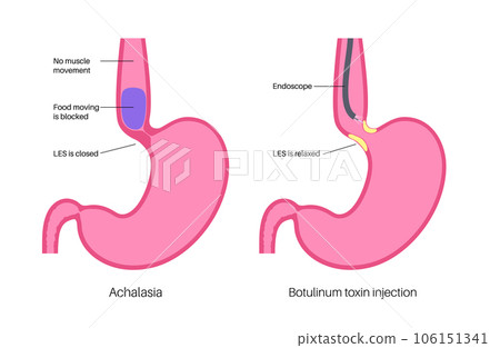 esophageal botulinum toxin injection - Stock Illustration [106151341 ...