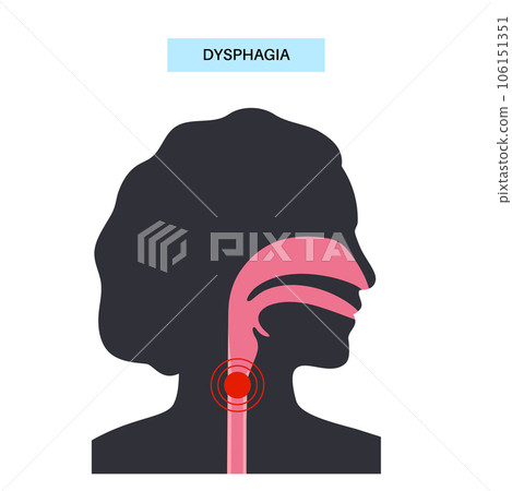 Dysphagia medical poster - Stock Illustration [106151351] - PIXTA
